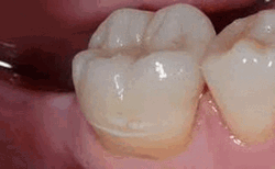 Fixed Dentures Teeth GIF | GIFDB.com